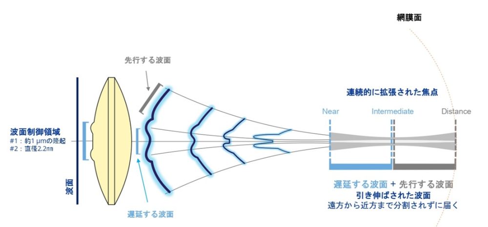 クラレオンビビティ（Clareon Vivity）｜大阪・京都の医療法人 創夢会眼科グループ